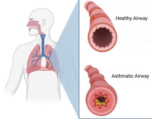 UNMASKING ASTHMA: EDUCATING AND STRENGTHENING LIVES - Invision Medi Science